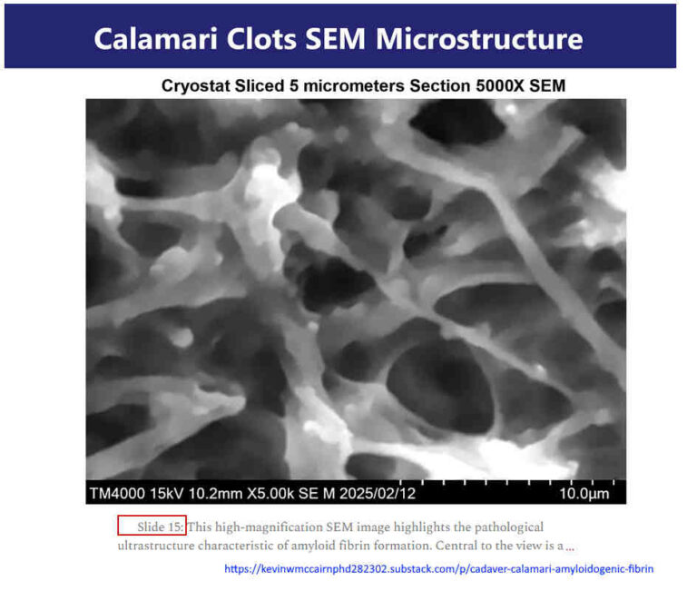 Embalmers are finding unusual clots | Totality of Evidence